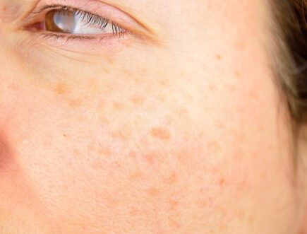 Solar Lentigo - Dermatology