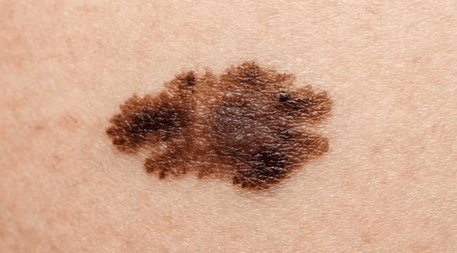 Mole Mapping | Full Body Mole Mapping by Dermatology