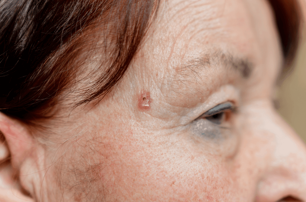 Mole Mapping | Full Body Mole Mapping by Dermatology