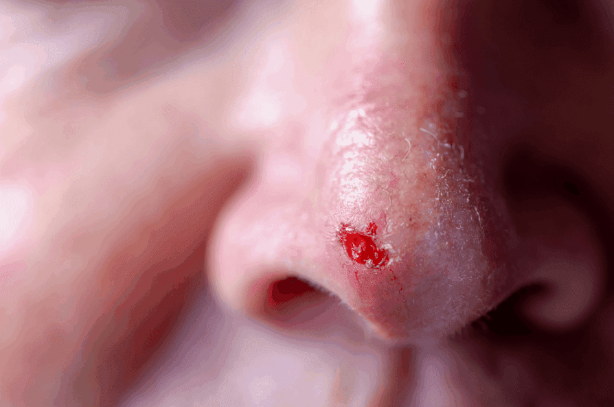 Mole Mapping | Full Body Mole Mapping by Dermatology