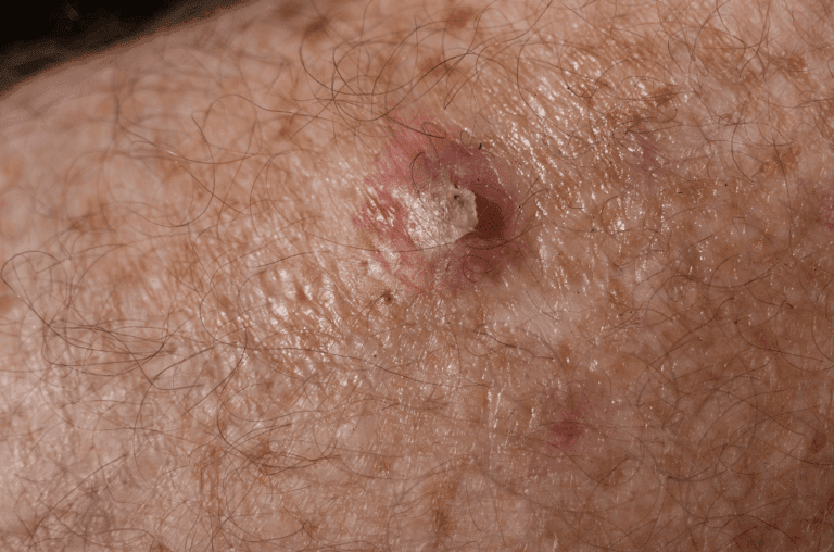 Mole Mapping | Full Body Mole Mapping by Dermatology
