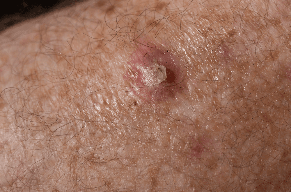 Mole Mapping | Full Body Mole Mapping by Dermatology