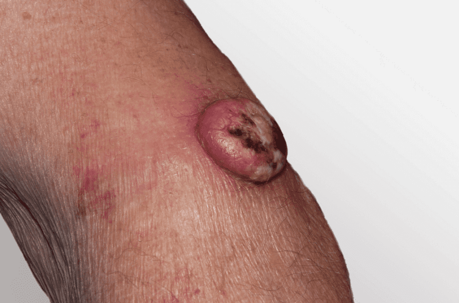 Mole Mapping | Full Body Mole Mapping by Dermatology