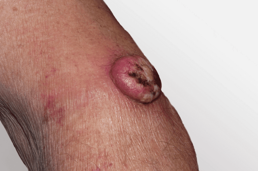 Mole Mapping | Full Body Mole Mapping by Dermatology